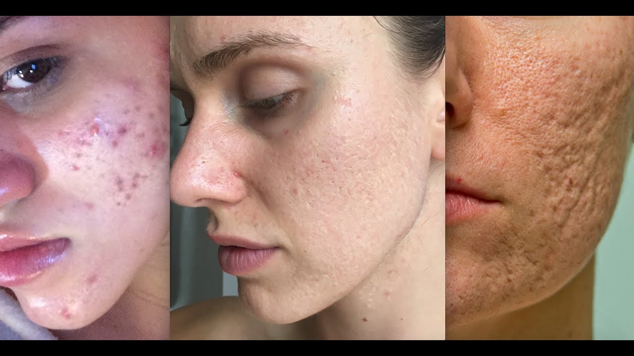 Best Acne Scar Treatment Dubai Abu Dhabi Laser Skin Care